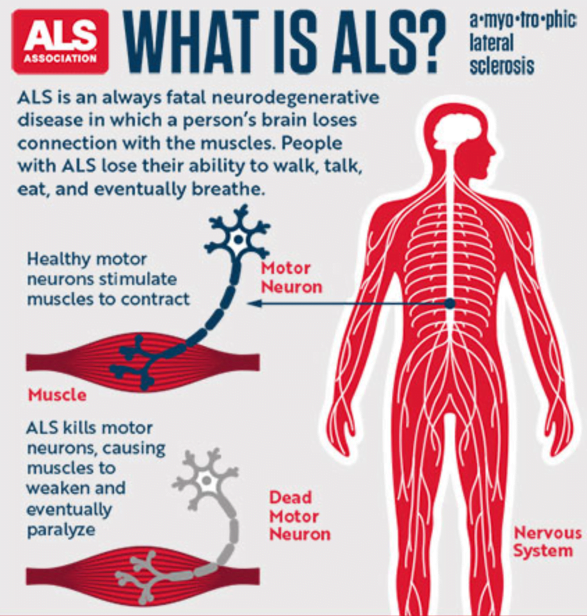 ALS amyotrophic Lateral Sclerosis Version 1 0 Frequency Research ALS amyotrophic Lateral Sclerosis Version 1 0 Frequency Research
